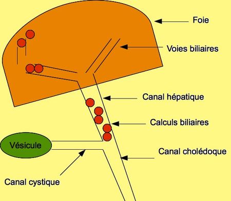 Angiocholite; cholangite